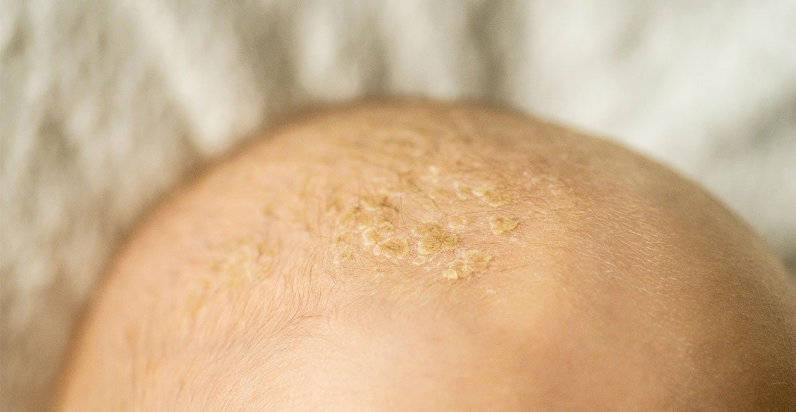 Seboroická dermatitida u kojence - Epiderma.cz